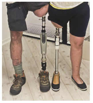 Prosthetic Limb Attachment Alternative Now In Texas